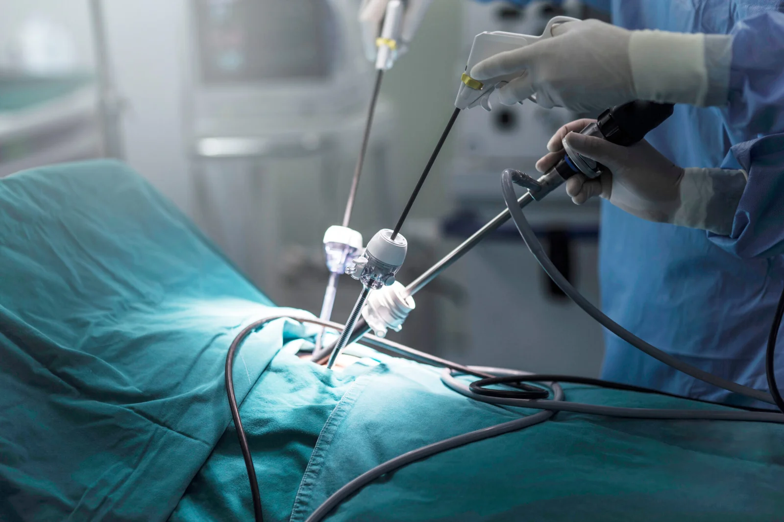 Laparoscopic Cancer Surgery - karnawat